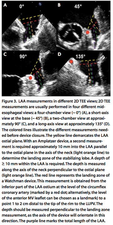 Echo Essentials for Endoluminal LAA Closure - Cardiac Interventions Today