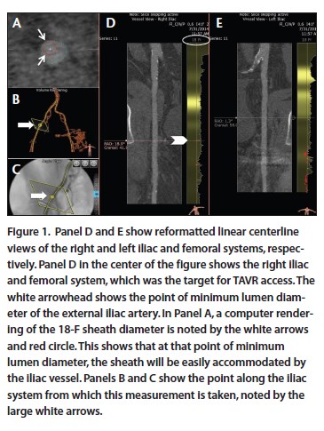 Optimal Femoral Access and Closure for TAVR - Cardiac Interventions Today