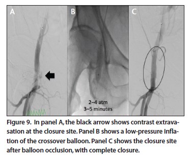 Optimal Femoral Access and Closure for TAVR - Cardiac Interventions Today