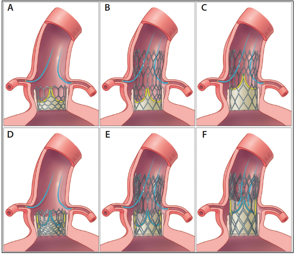 Cardiac Interventions Today TAVR In Patients With Aortic Stenosis And Cardiac Interventions Today TAVR In Patients With Aortic Stenosis And